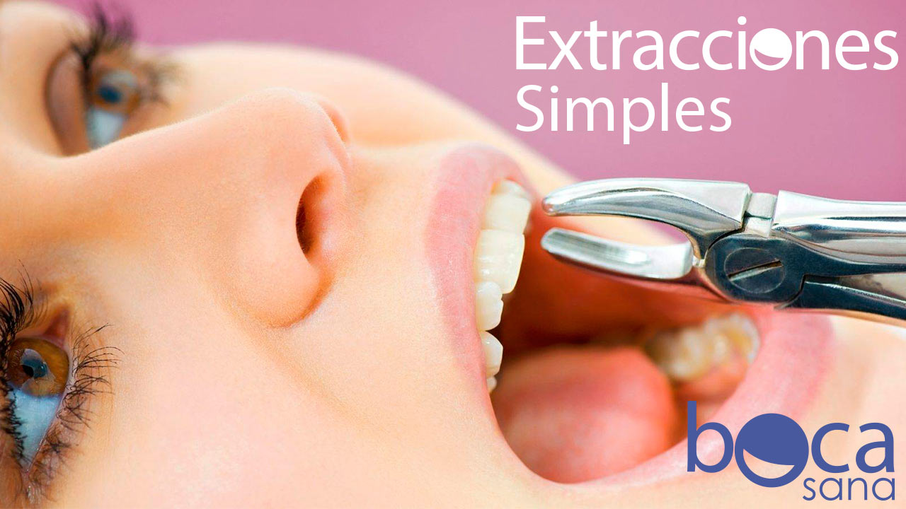 extracciones Simples ¿que son? - Boca Sana